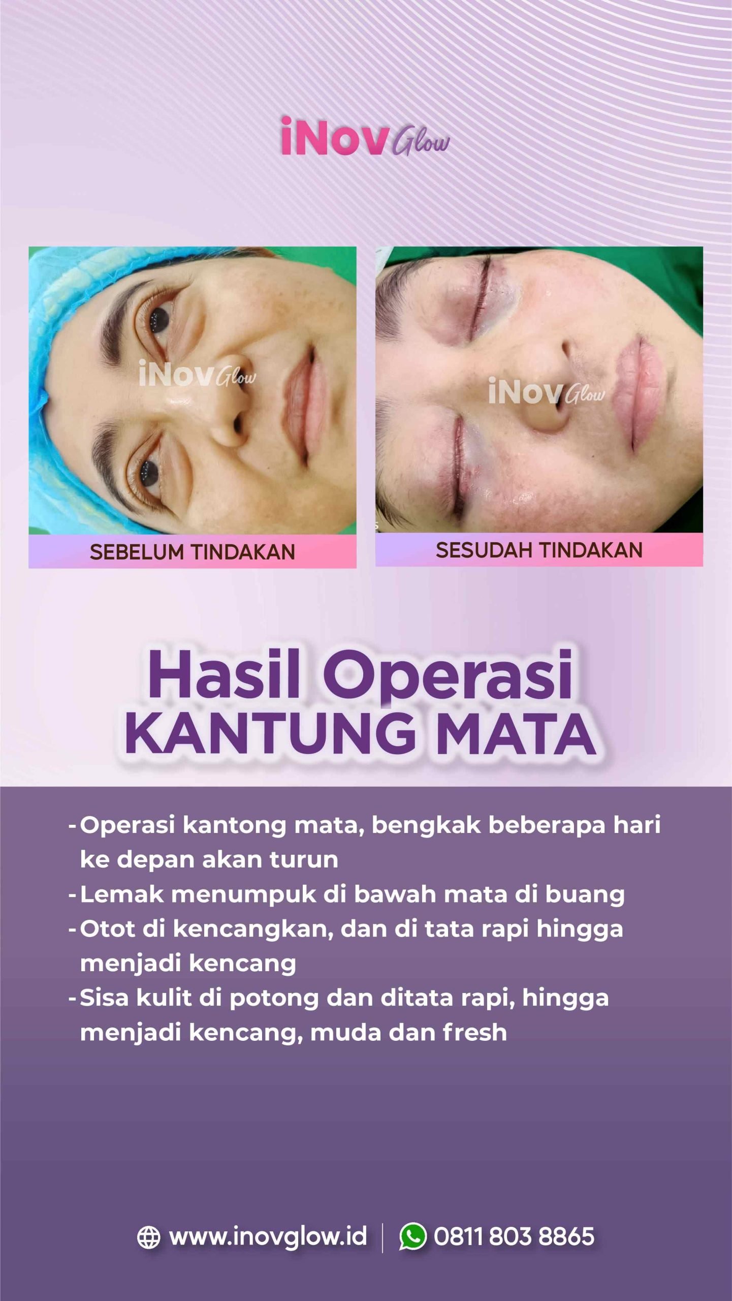 Mempercantik Diri Melalui Operasi Kelopak Mata Bawah - SPESIALIS BEDAH ... Mempercantik Diri Melalui Operasi Kelopak Mata Bawah - SPESIALIS BEDAH ...